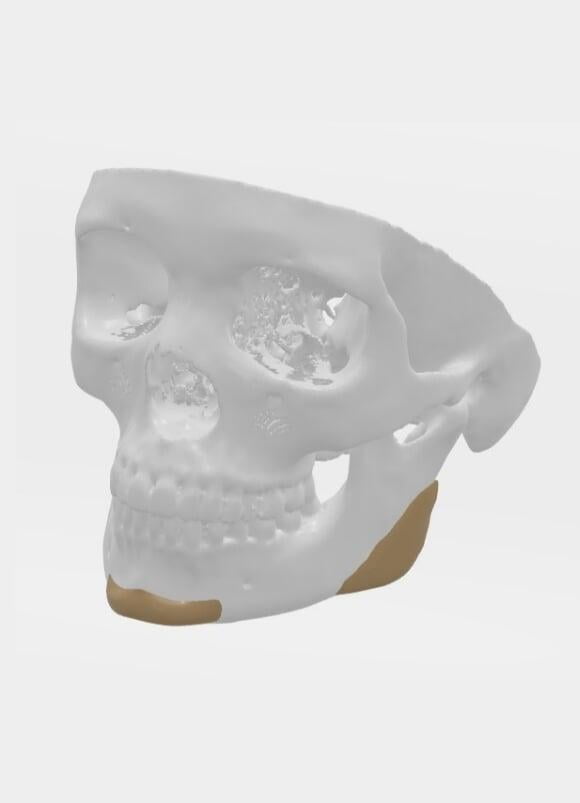 Facial Plastic Surgery | LUCID Implants